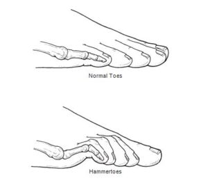 What Is Hammertoe? - TOMS RIVER DIABETIC WOUND CARE SPECIALIST | Toms ...