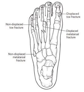 Toe and Metatarsal Fractures - TOMS RIVER DIABETIC WOUND CARE ...